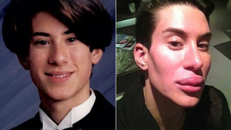 Justin Jedlica chirurgien esthétique : Le Ken Humain opéré en Turquie